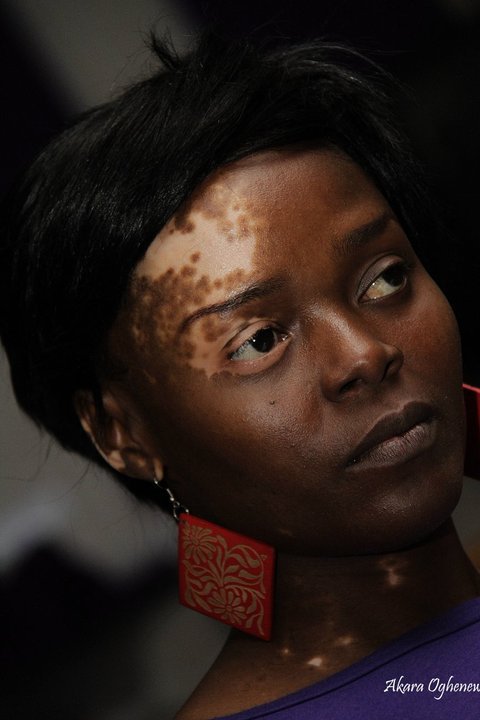 BN Skin Deep Series: "The White Spot that Changed My Life" - Living ...