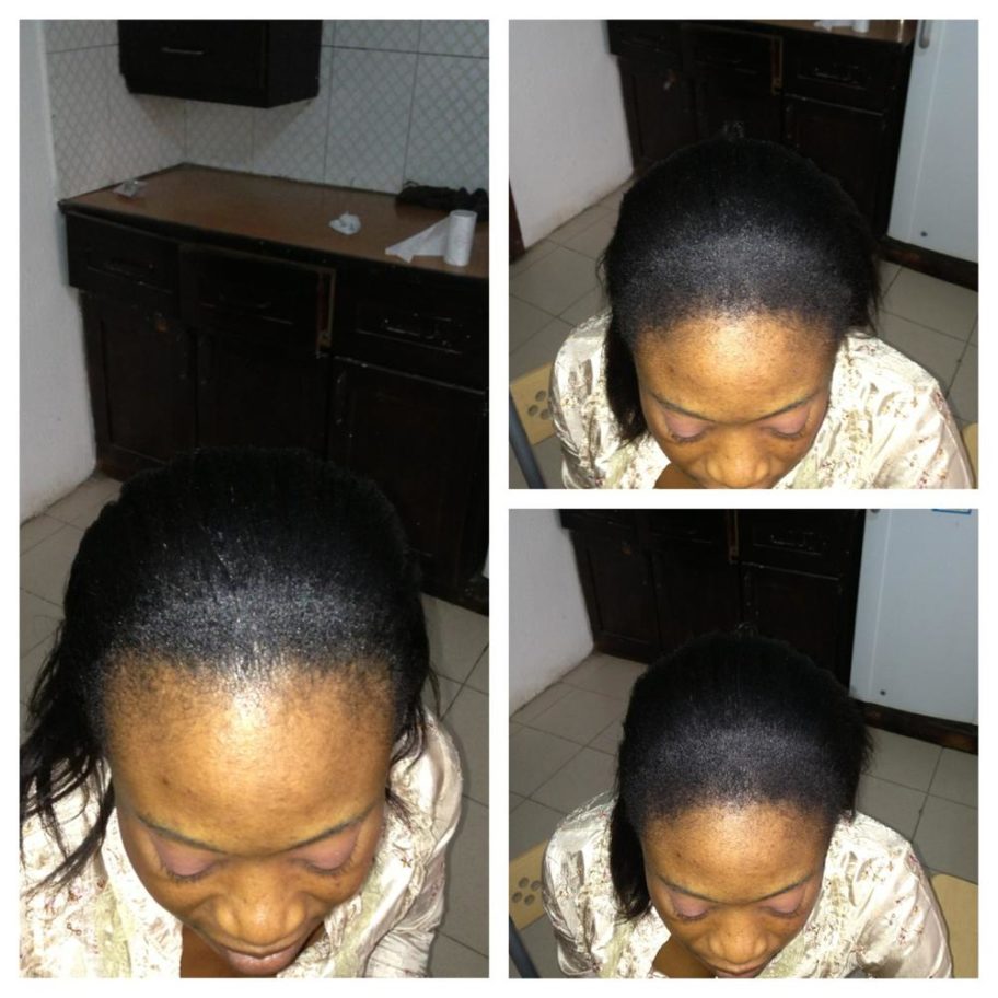 A Quick Fix for Your Bald Spots & Damaged Hairline - Super Million Hair ...