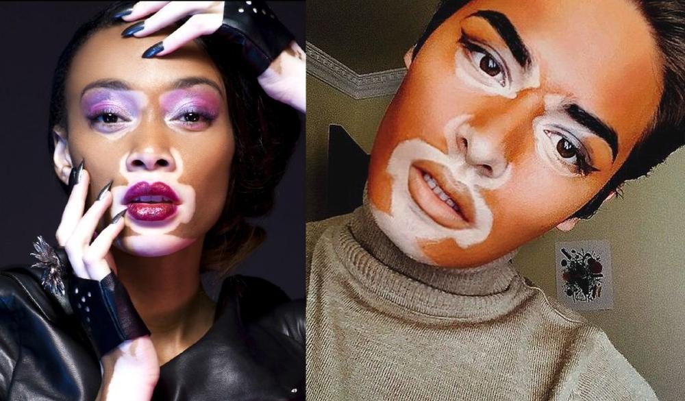 Model Winnie Harlow is Not Offended by People Recreating Her Vitiligo ...