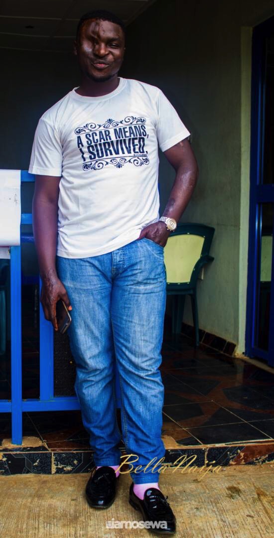 BN Our Stories, Our Miracles: Ayodeji Lost his Left Eye, Had a Cracked ...