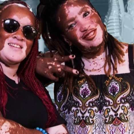 Diversity! ?? CoverGirl's Latest Campaign features Model with Vitiligo ...