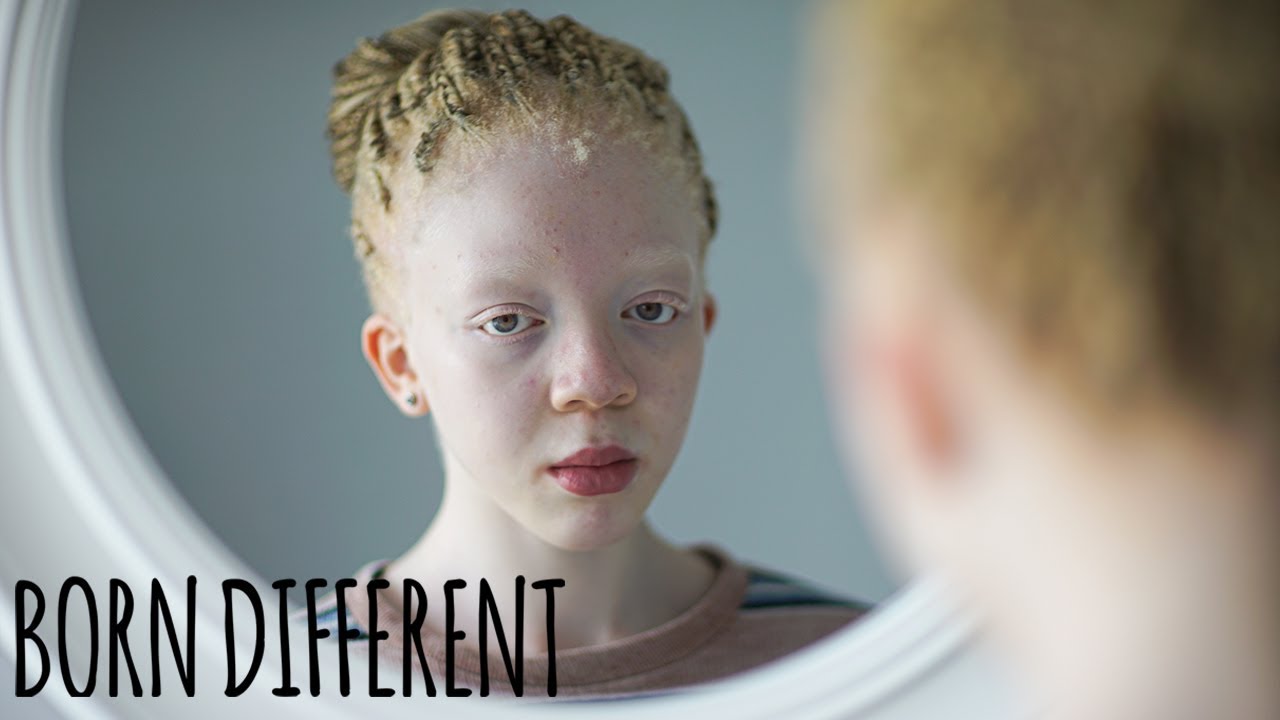 "I’m Black, Even With Albinism" - This Teenager is determined to Follow ...