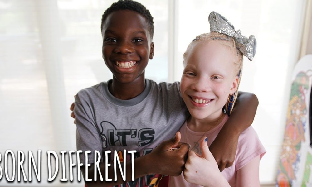 Born Different: 9-Year-Old She’riq was Born with Albinism & her Twin ...