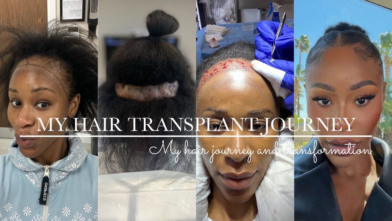 Get Inspired by Mariam Musa's Remarkable Hair Transplant Journey ...