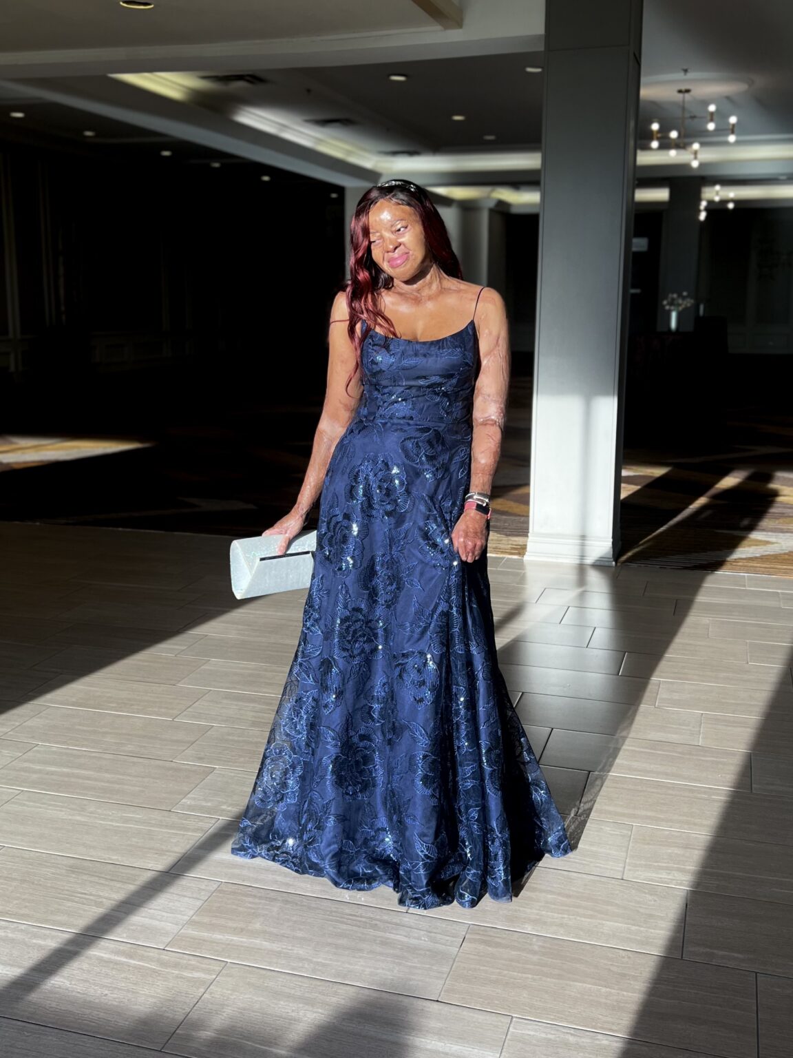 Kechi Okwuchi Discusses Living Beyond Her Scars & Being an Inspiration ...